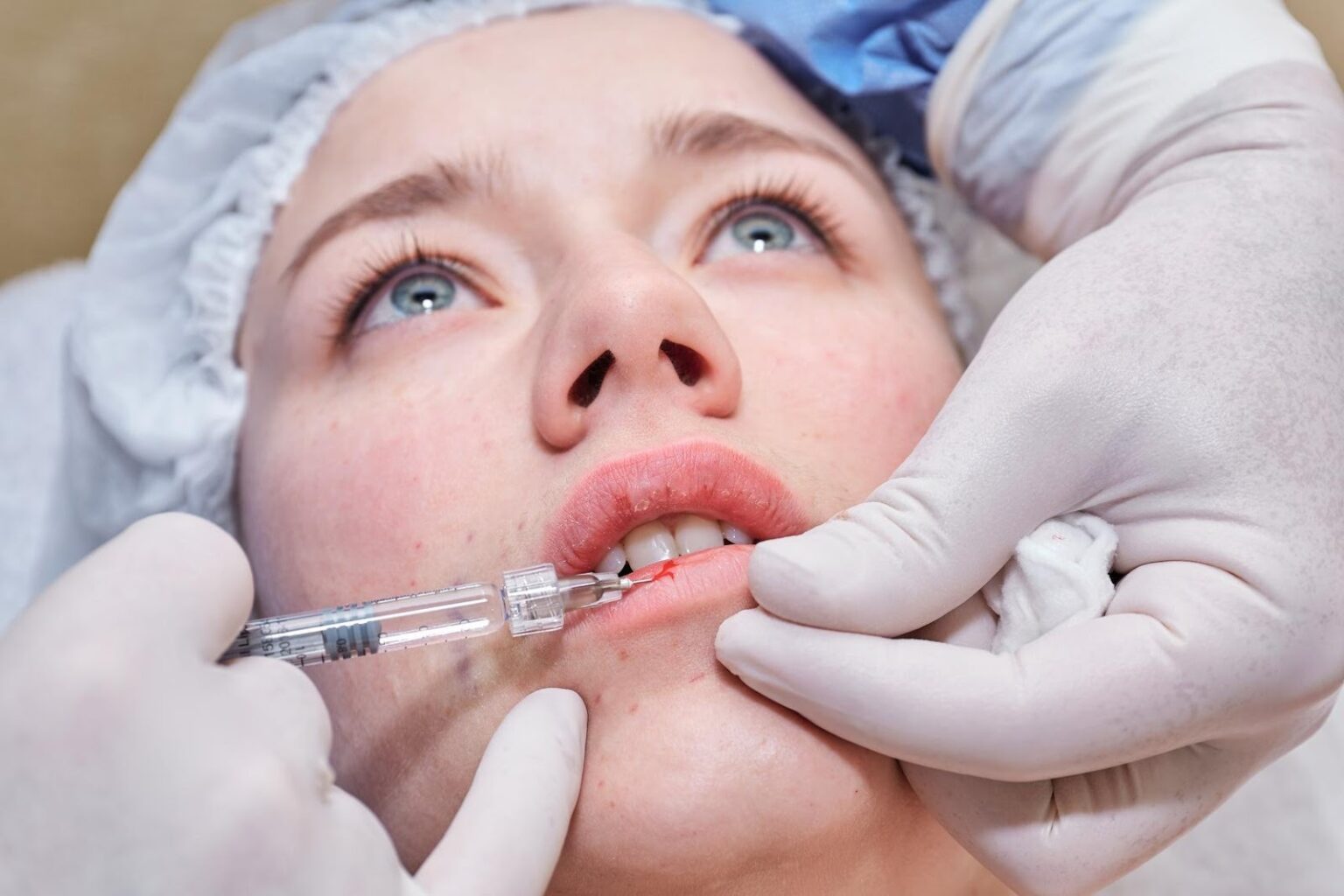 Where Not to Inject Lip Filler – Essential Safety Zones for New and ...